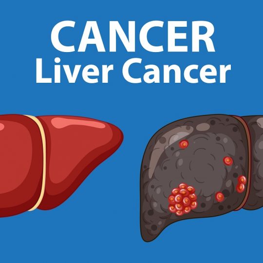 What Does Cancer Look Like on a CT Scan With Contrast?