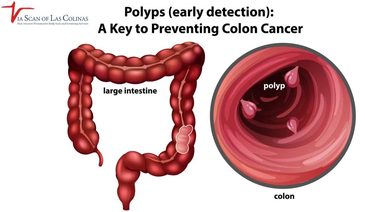 How Many Polyps Are Normal in a Colonoscopy? - Viascan